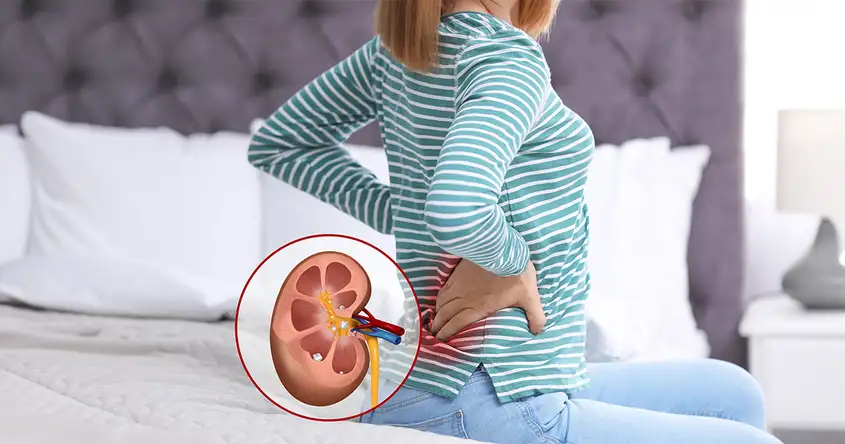 Bladder Calculi vs Kidney Stones: Understanding the Difference