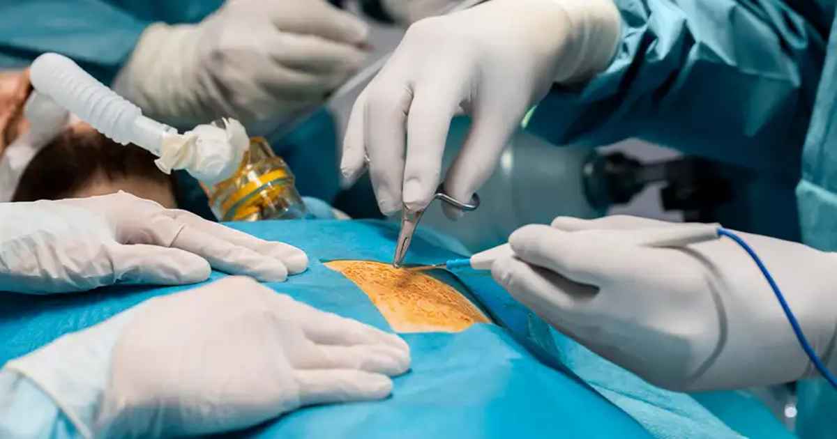 Cryptorchidism Surgery: What to Expect and Recovery Tips