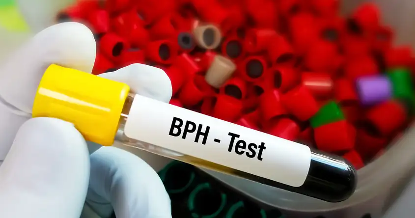 Diagnosing BPH: Tests and What to Expect
