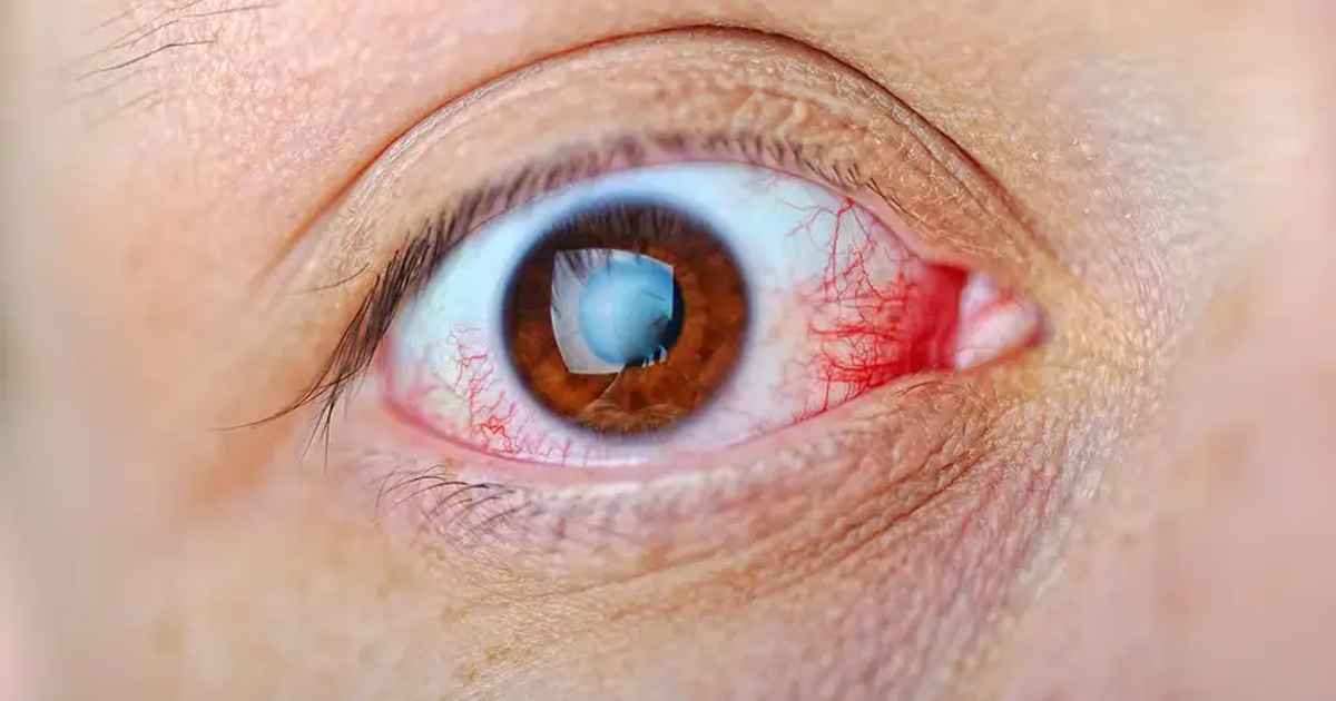 Ocular Chlamydia Infection: Frequently Asked Questions